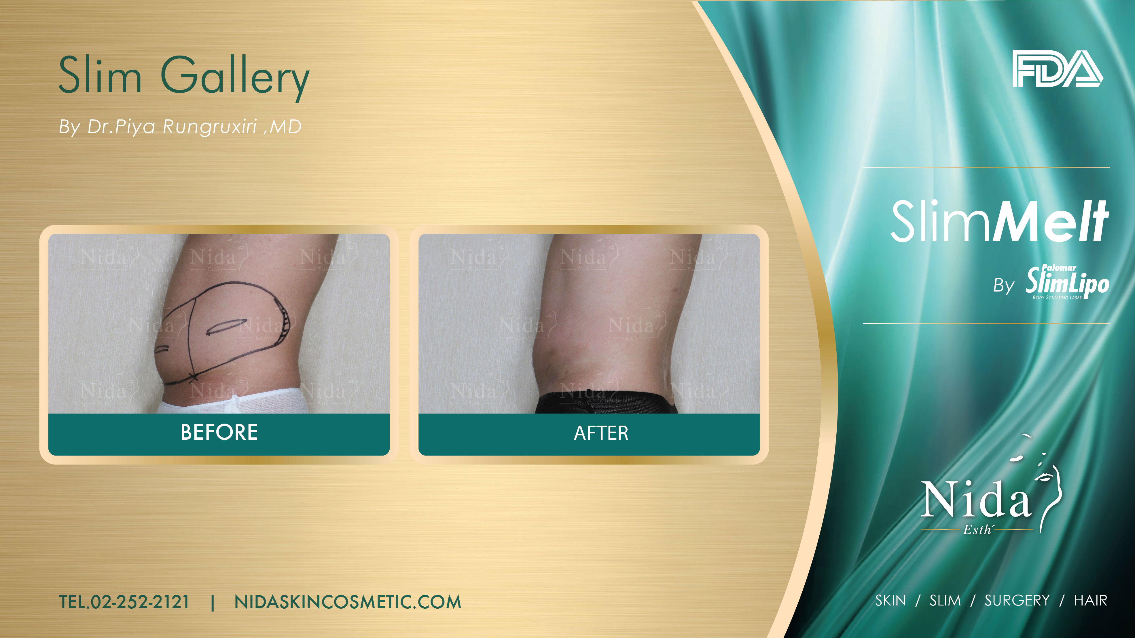 Abdomen liposuction | Nida Esthetic Cosmetic Surgery Bangkok