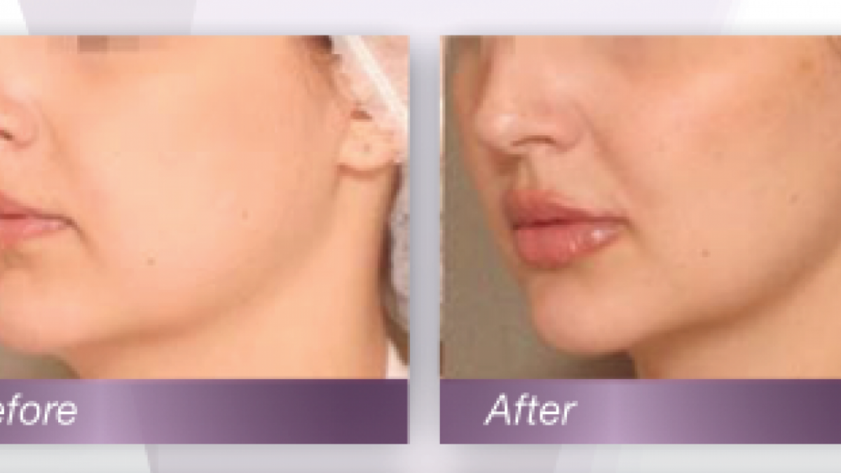 V Shape Laser | Nida Esthetic Cosmetic Surgery Bangkok
